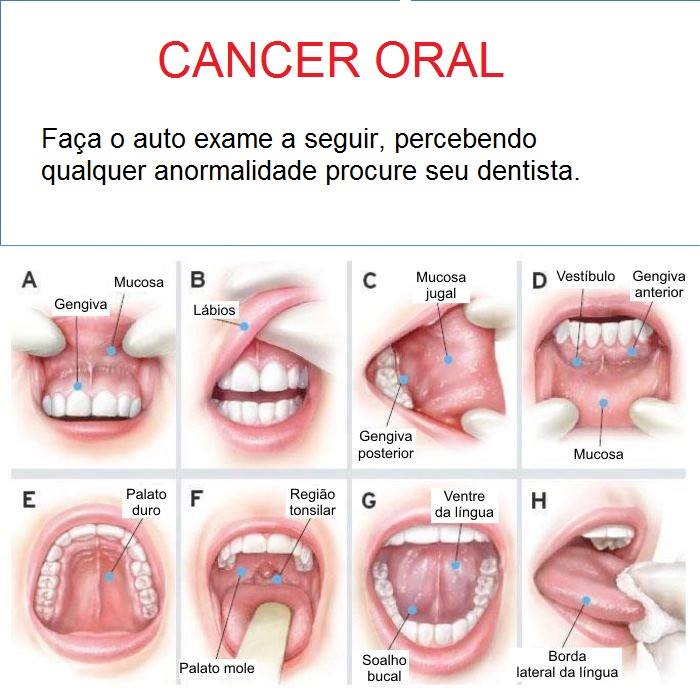 Cancer De Boca Sintomas